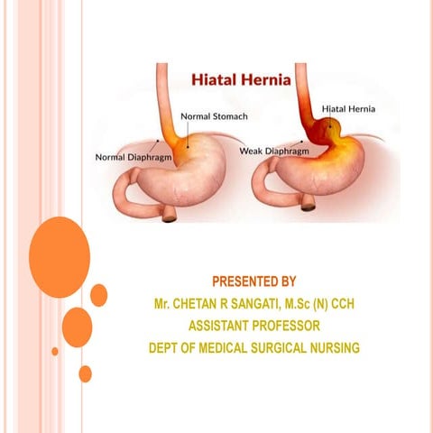 Ppt Endoscopic Diagnosis Of Hiatal Hernia Powerpoint