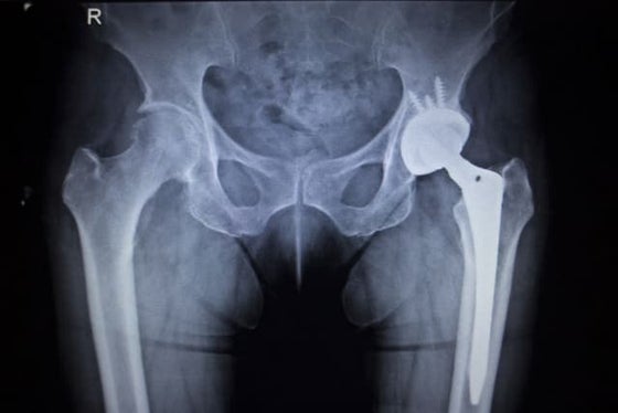 Total Hip Replacement | PPT