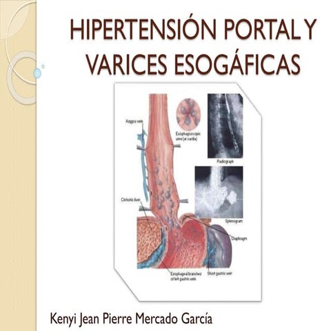 Anatomía De Las Varices Esofágicas