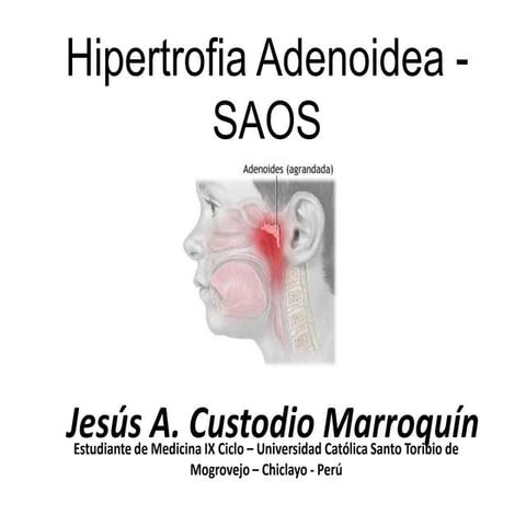 Hipertrofia Adenoidea - SOAS | PPT