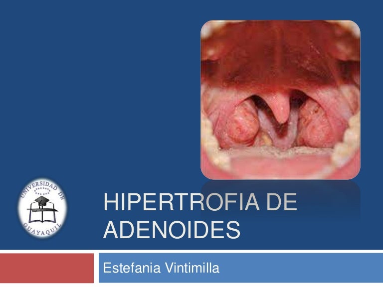 Hipertrofia de adenoides