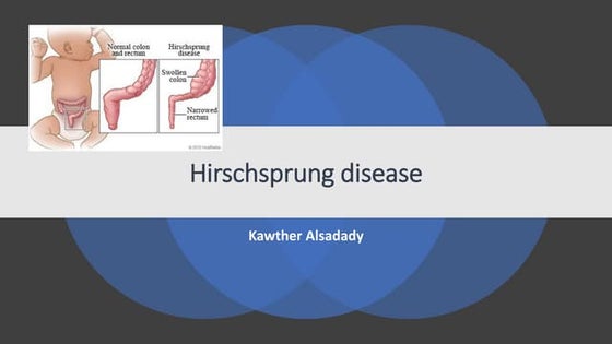 HIRSCHSPRUNG DISEASE | PPTX