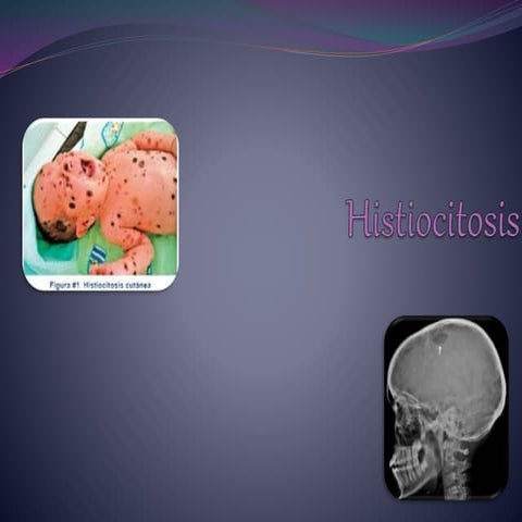 Histiocitosis de células de langerhans | PPTX