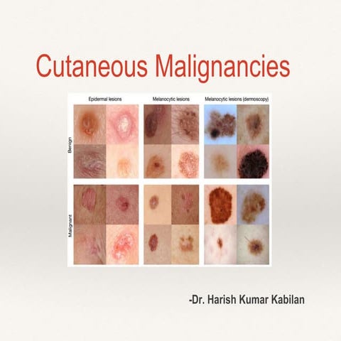 Malignant tumors of skin