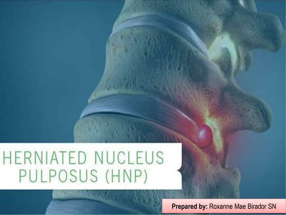 Herniated Nucleus Pulposus (HNP).pptx | Physical Therapy | Wellness