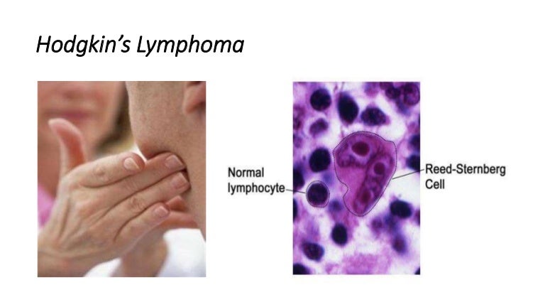 Hodgkin lymphoma