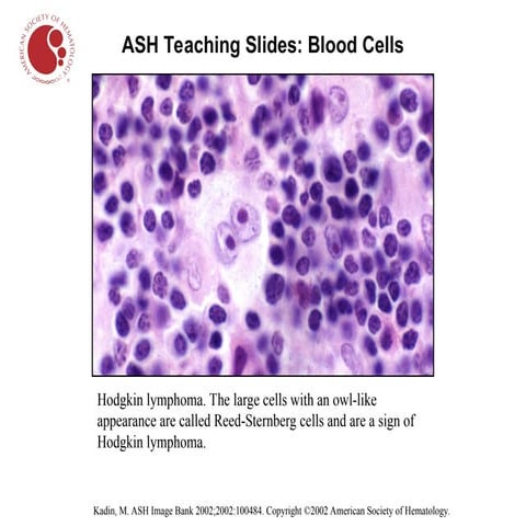 Hodgkin Lymphoma classic and nlphl lymphadenopathy.ppt