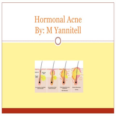 Hormonal acne | PPTX