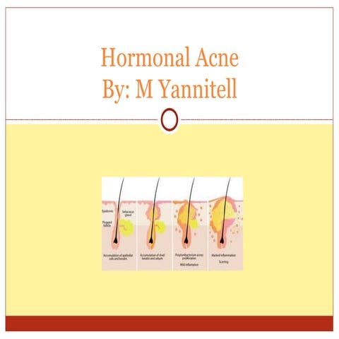 Hormonal acne copy | PPT