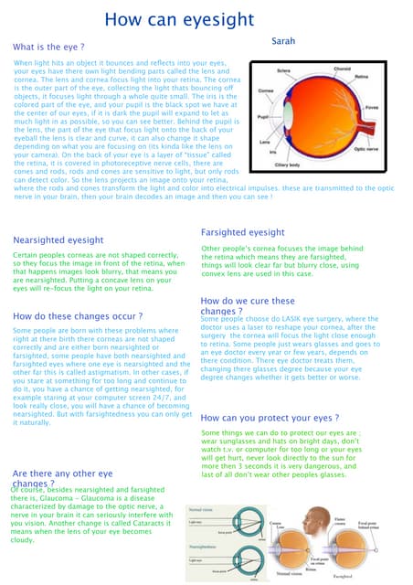 Presentation of eye ths | PPT