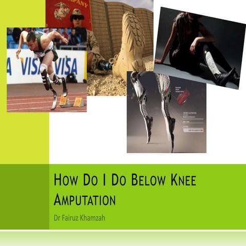 How to Perform a Below Knee Amputation | PPT