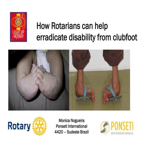 How Rotarians Can Help Eradicate Disability From Clubfoot Birth Defect ...