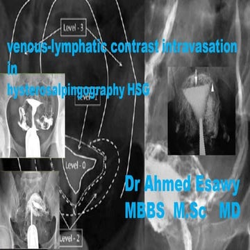 How to avoid contrast venous lymphatic reflux in HSG | PPTX