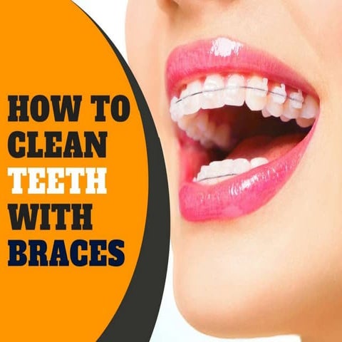 How to Clean Teeth with Braces | PPT