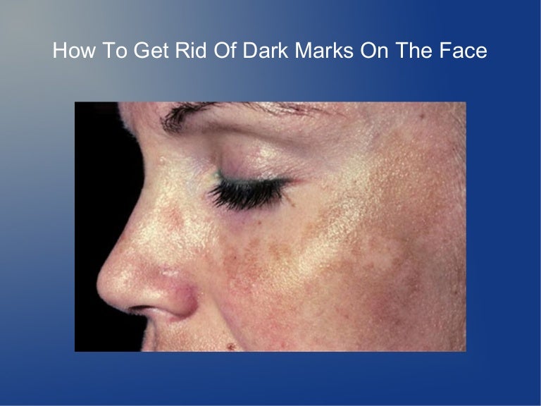 How To Get Rid Of Dark Marks On The Face how-to-get-rid-of-dark-marks-on-the-face