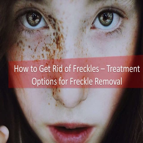 How to Get Rid of Freckles – Treatment Options for Freckle Removal | PPTX