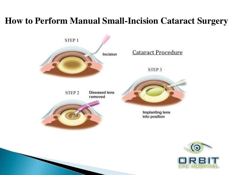 How to perform manual small incision cataract surgery