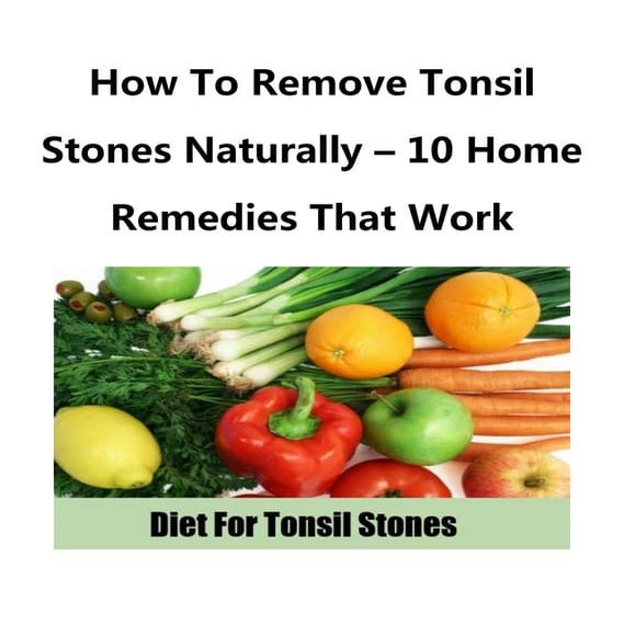 How to remove tonsil stones naturally 10 home remedies that work | PDF