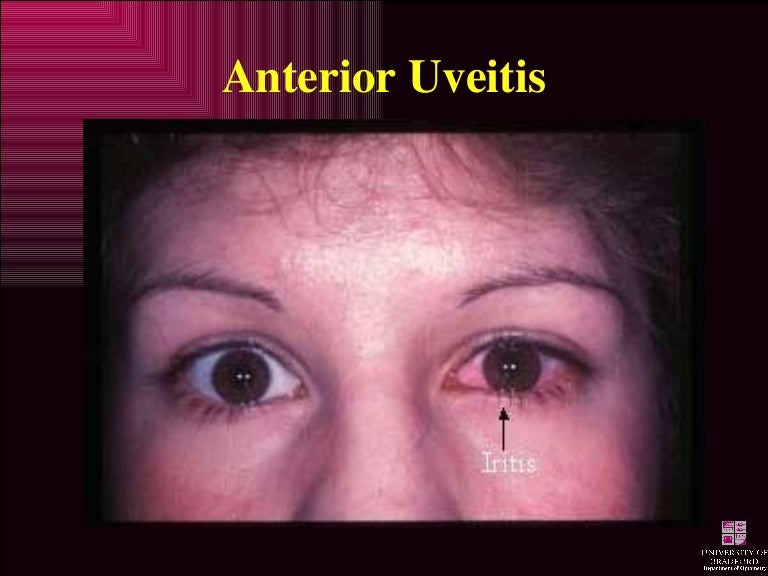 Anterior Uveitis