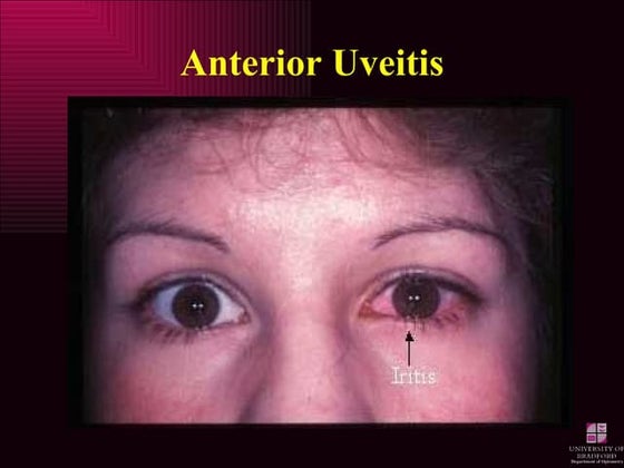 Uveitis | PPT