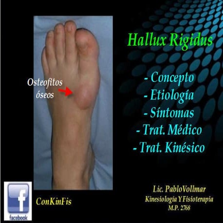 Hallux rigidus | PPTX