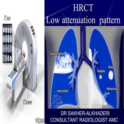 HRCT LUNG-BASIC INTERPRETATION | PPT