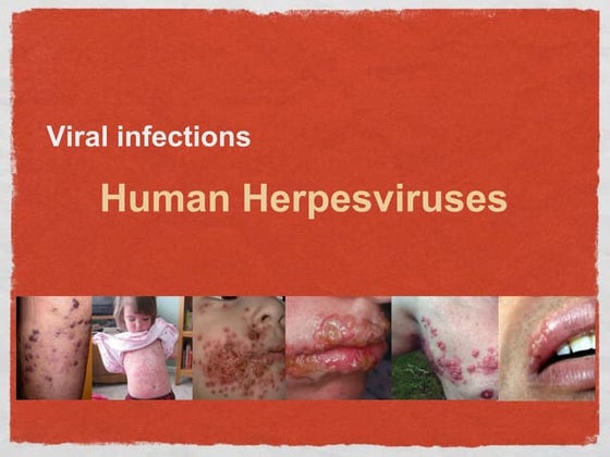 Herpes simplex virus | PPT