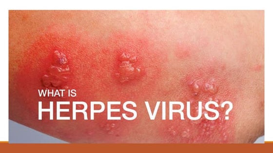 Herpes simplex virus | PPT