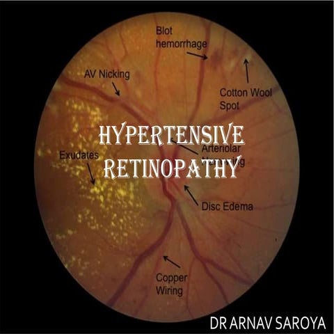 HYPERTENSIVE RETINOPATHY - DR ARNAV SAROYA | PPTX