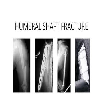 Humeral Shaft Fracture.pptx