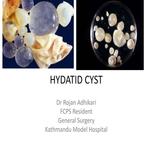 Hydatid cyst | PPTX | Digestive Disorders | Diseases and Conditions