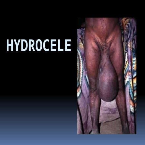 HYDROCELE , complications and its management | PPTX