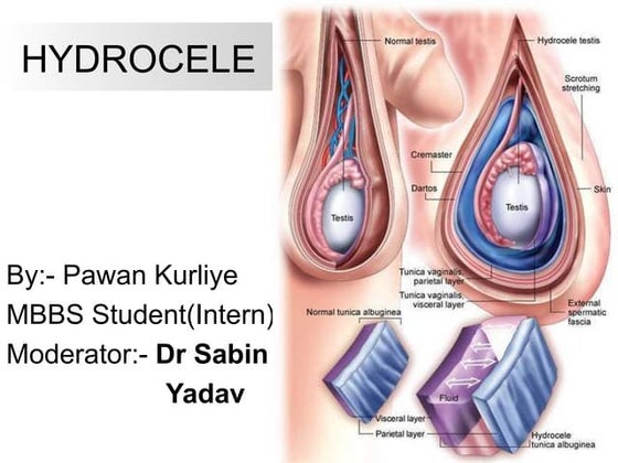 Hydrocele | PPTX | Sexual Conditions | Sexual Health