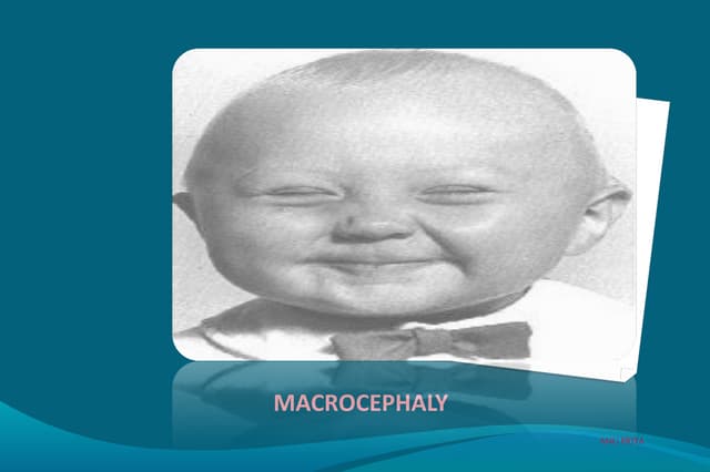 Approach to Macrocephaly / large head, Megalencephaly, Causes(Etiology ...