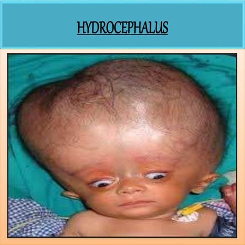 hydrocephalus-180822081453.pdf