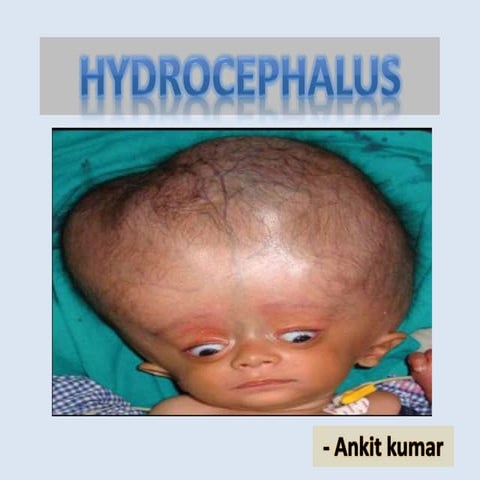 Hydrocephalus