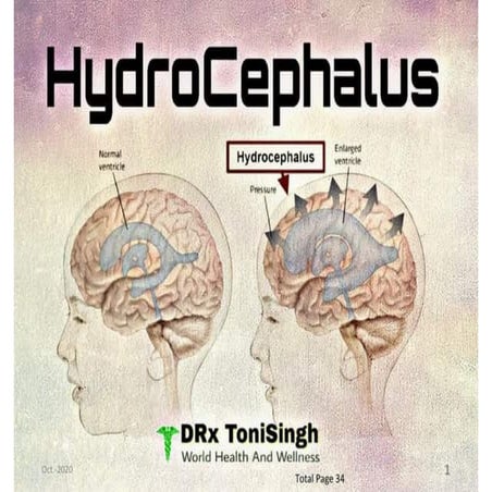Hydrocephalus | PDF