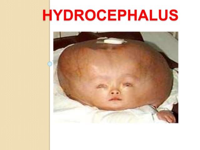 Hydrocephalus disease | PPTX | Brain and Nervous System Disorders | Diseases and Conditions