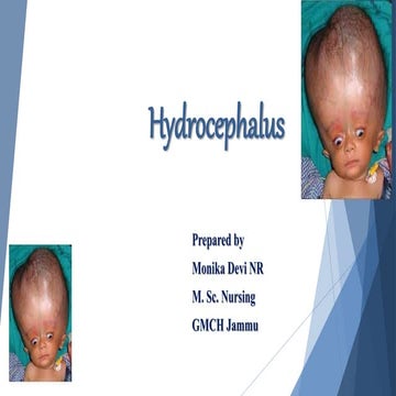 hydrocephalus.pptx