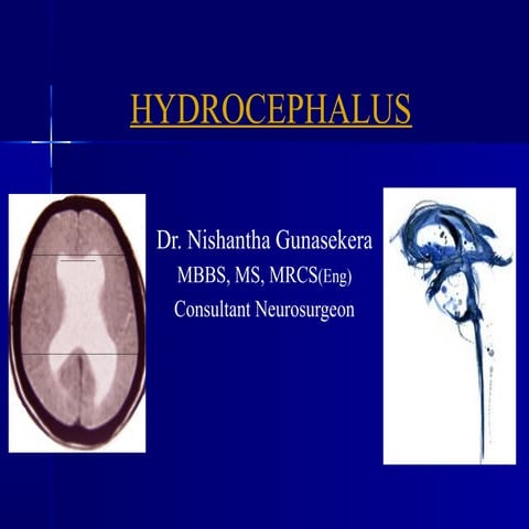 Hydrocephalus.Dr NG NeuroEdu | PPT