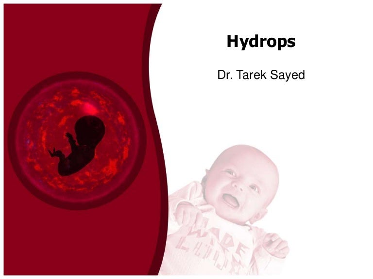 Hydrops