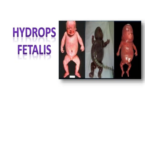 hydrops%20fetalis.pptx | Pregnancy | Reproductive Health