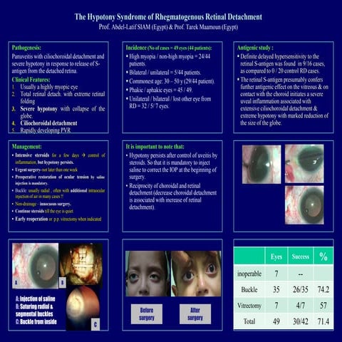 The Hypotony Syndrome of Rhegmatogenous Retinal Detachment | PPTX