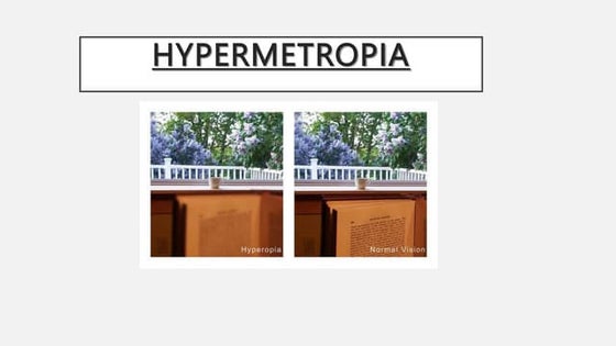 Hypermetropia.dhggjjkkkgffbdoastudenpptx | PPT