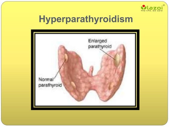 Primary hyperparathyroidism | PPT
