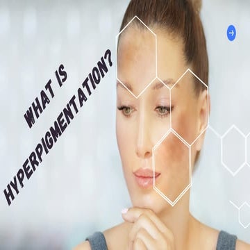 What Is Hyperpigmentation? | PDF