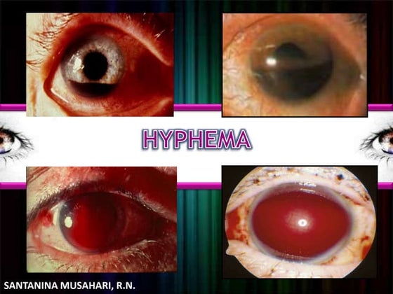 hypopyon vs ................hyphema.pptx