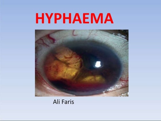 hypopyon vs ................hyphema.pptx