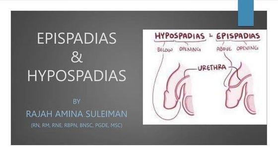 Epispadias | PPTX | Sexual Conditions | Sexual Health