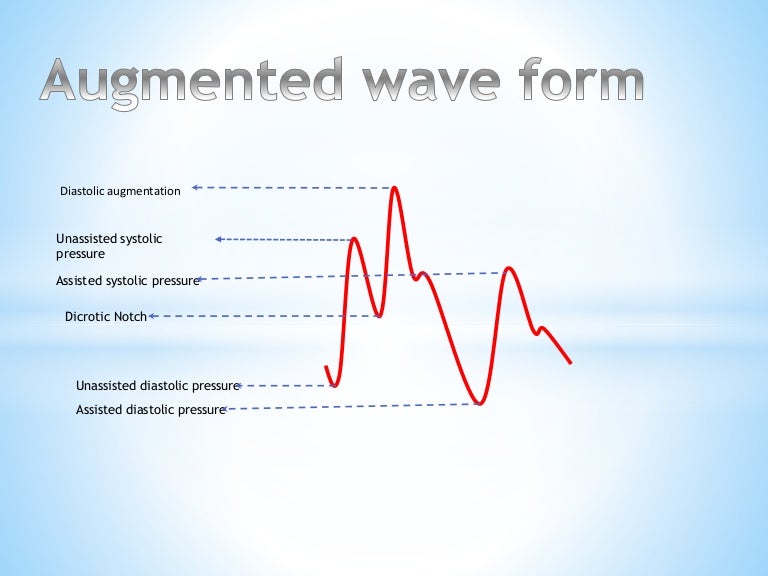 Iabp wave forms